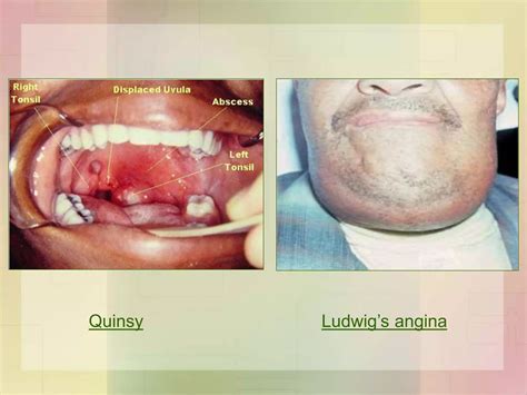 Streptococcus And Enterococcus By Dr Rakesh Prasad Sah Pptx
