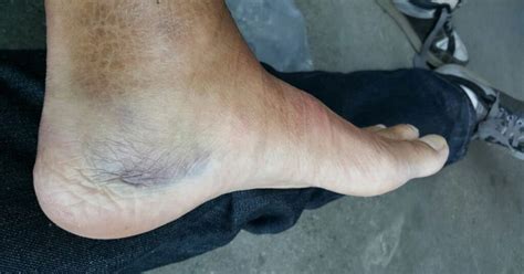 Ankle Dislocation Medical Centric