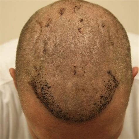 Top 181 Scalp Necrosis After Hair Transplant Polarrunningexpeditions
