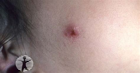 Cat Scratch Disease Image