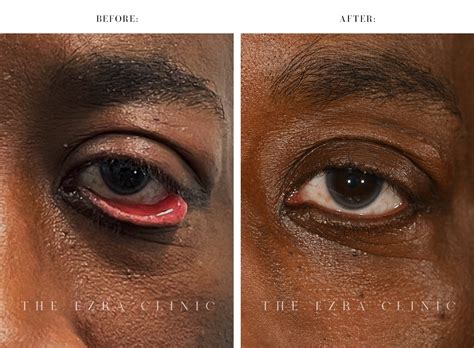 Ectropion Eyelid Surgery