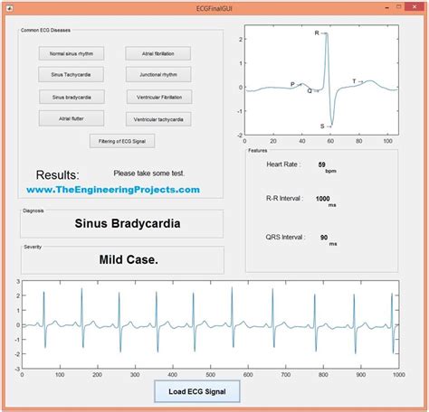 ECG Simulation Using MATLAB The Engineering Projects