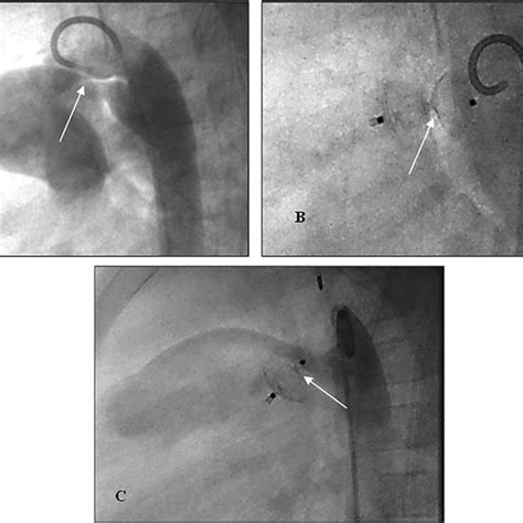 Angiograms For Patient With Residual Shunt A Pda Entering The Pa