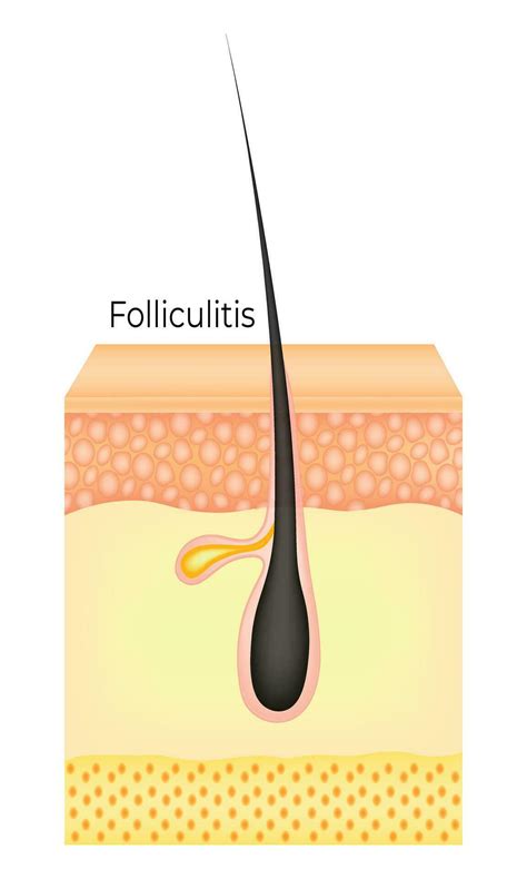 Folliculitis Science Design Vector Illustration Diagram 36491334 Vector