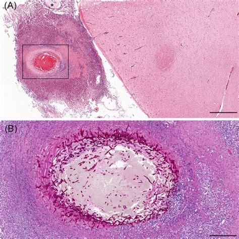 The Right Medial Retropharyngeal Lymph Node Was Enlarged A And On
