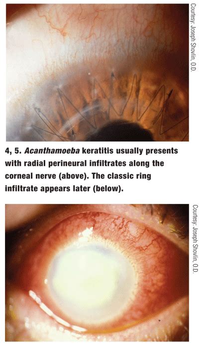 Acanthamoeba Corneal Ulcer