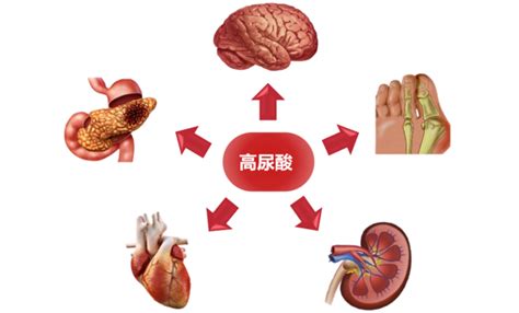 如何治疗高尿酸血症？再造人
