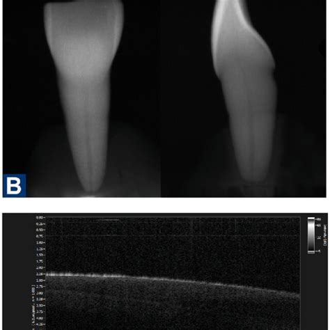 example showing a control tooth incisor a clinical photo b