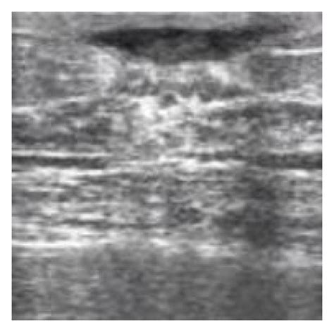 image cutting of benign breast tumor a original picture b elawady