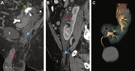 Ct Urogram Showing Crossed Fused Renal Ectopia With Left Download