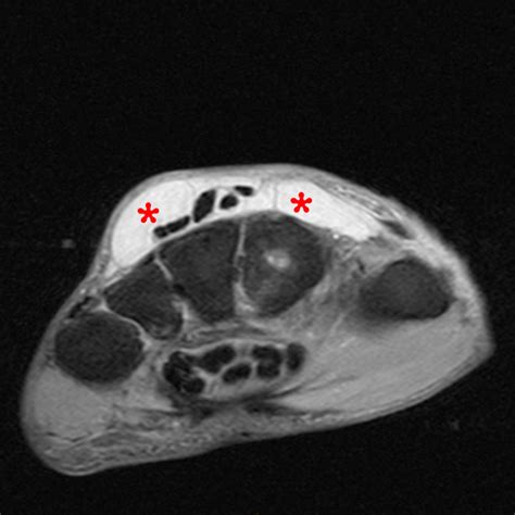 Stenosing Tenosynovitis Of The 4th Extensor Compartment Radsource