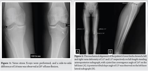 Tibial Based Posterolateral Corner Reconstruction Following Proximal