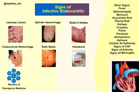 Infective Endocarditis Signs And Symptoms