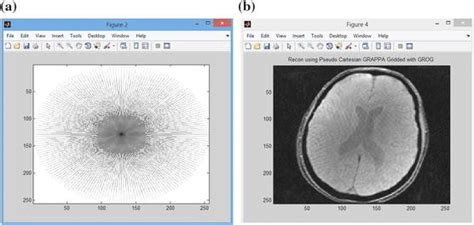 5a Undersampled K Space Data Gridded Grog And B The Ifft Of The