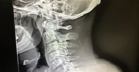 chiropractor wants to charge me 420 to fix alignment issue legit or no album on imgur