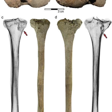 Comparison Between The Right Tibia Left Column And The Left Tibia