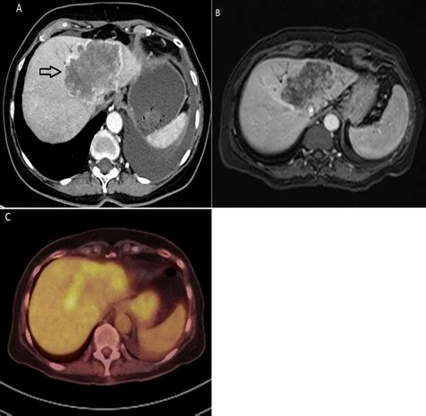 Role Of Diagnostic Radiology In The Management Of Intrahepatic