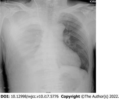 Left Hemothorax X Ray