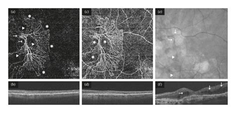 Clinically Active Predominantly Hyperdense Choroidal Neovascularization Download Scientific