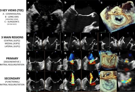 Essential Echo Views In Screening For Mitral Regurgitation The Key Download Scientific Diagram