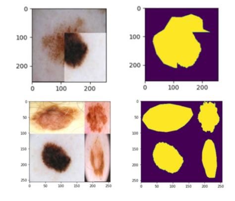 Top Row Cutmix Augmentation Applied On An Image From The Isic 2016