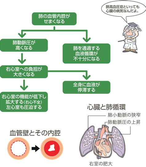 肺高血圧症 JapaneseClass jp