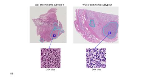 Extraction Of Tiles From Annotated Whole Slide Images WSI Of Two