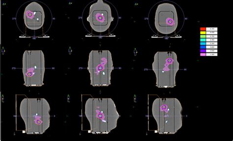 Planning CT And Isodose Distributions In Transversal Coronal And Download Scientific Diagram