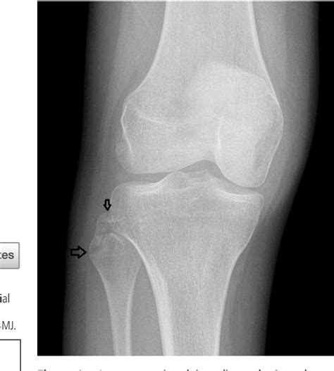 Proximal Fibula Fracture