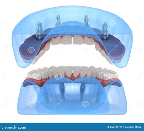 Maxillary And Mandibular Prosthesis With Gum All On 4 System Supported By Implants Medically
