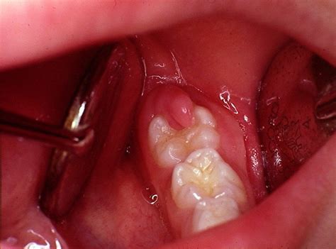 Pericoronitis Pictures Treatment Symptoms Causes