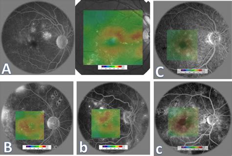 Synthetic Optical Coherence Tomography Color Coded Macular Thickness Download Scientific