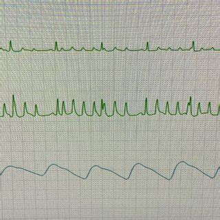 Welldeveloped Oxygen Pleth Waveform Bottom Blue Occurring At The Download Scientific Diagram