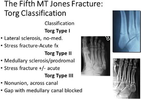 5th Metatarsal Jones Fracture