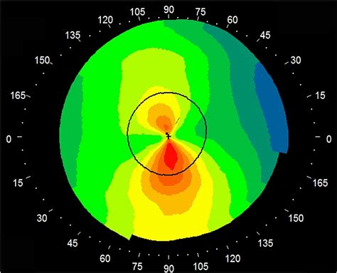 Normal Corneal Topography