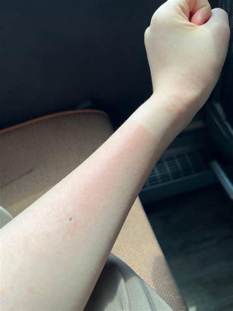 이거 햇빛 알레르기 인가요 지식in