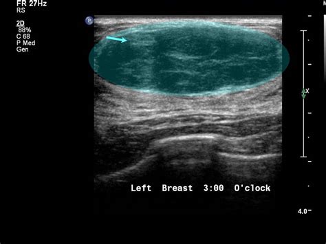 Atlas Of Breast Cancer Early Detection Atlas Of Breast Cancer Early Detection