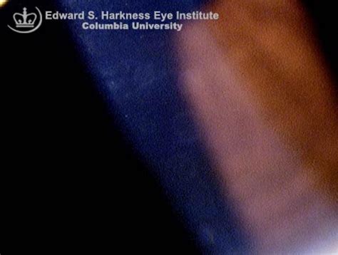 Posterior Polymorphous Dystrophy Vagelos College Of Physicians And