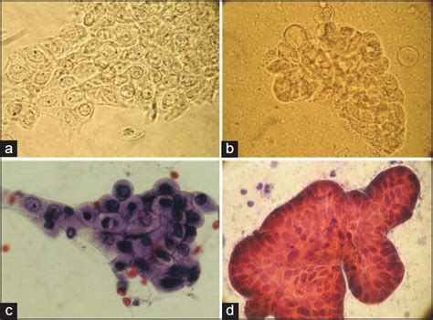 Vesical Tumor Image Of Cells In A Papillary Arrangement Of A Benign