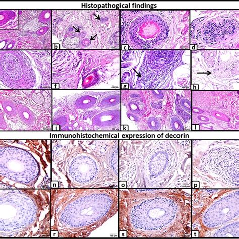 Excellent Improvement In A Female Patient With Patchy Alopecia Areata
