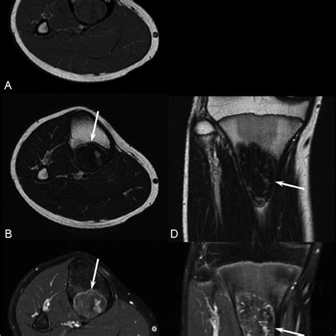 A 12 Year Old Man With Nonossifying Fibroma Of The Right Tibia A 12 Year Old Man With Nonossifying Fibroma Of The Right Tibia