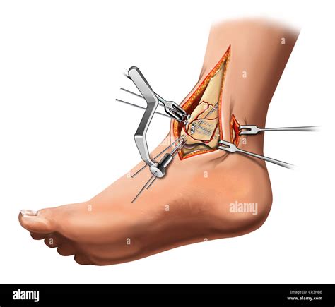 Medial Malleolus Of Tibia