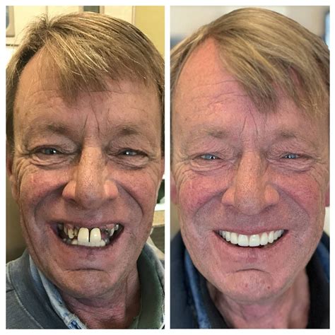 Patients Transformations Dr James Catt Dmd Pc
