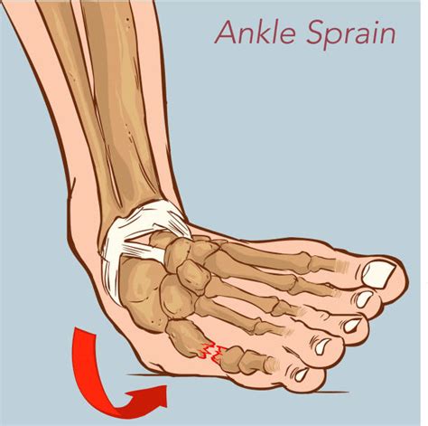 Ankle Sprain Illustrations Royalty Free Vector Graphics And Clip Art