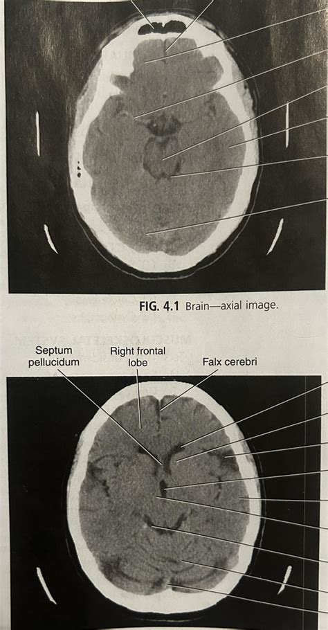 Ct Brain Diagram Quizlet