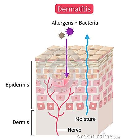 Atopic Dermatitis Eczema Skin Layer Illustration Disrupt Moisture