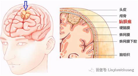 脑膜瘤常见问题解答临沂市人民医院神经外 脑膜瘤 蛛网膜 肿瘤 治疗 检查 健康界