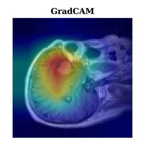 Transfer Learning And Explainable Ai For Brain Tumor Classification A