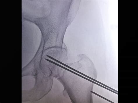 U Arm High Frequency X Ray Machineandu Arm Digital Radiology Sontu China