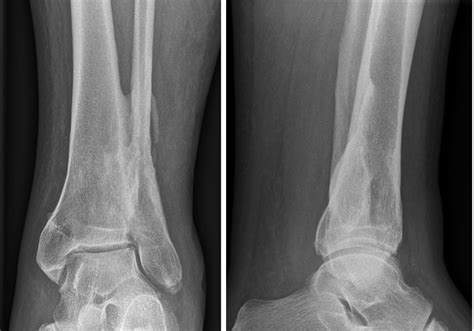 Joint Calcification And Ossification At Cameron Burke Gaffney Blog